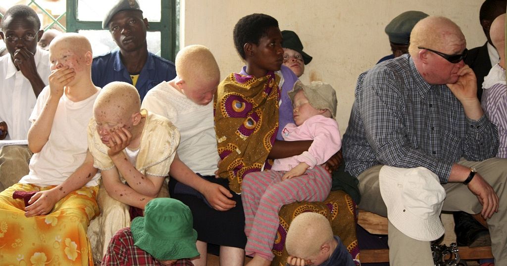 Endangered albinos in Malawi risk 'systematic extinction' - UN Expert ...