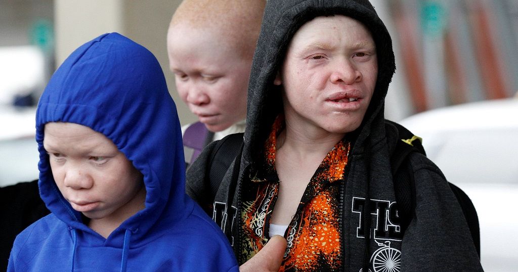 Four Tanzanian children with albinism in US for medical treatment ...