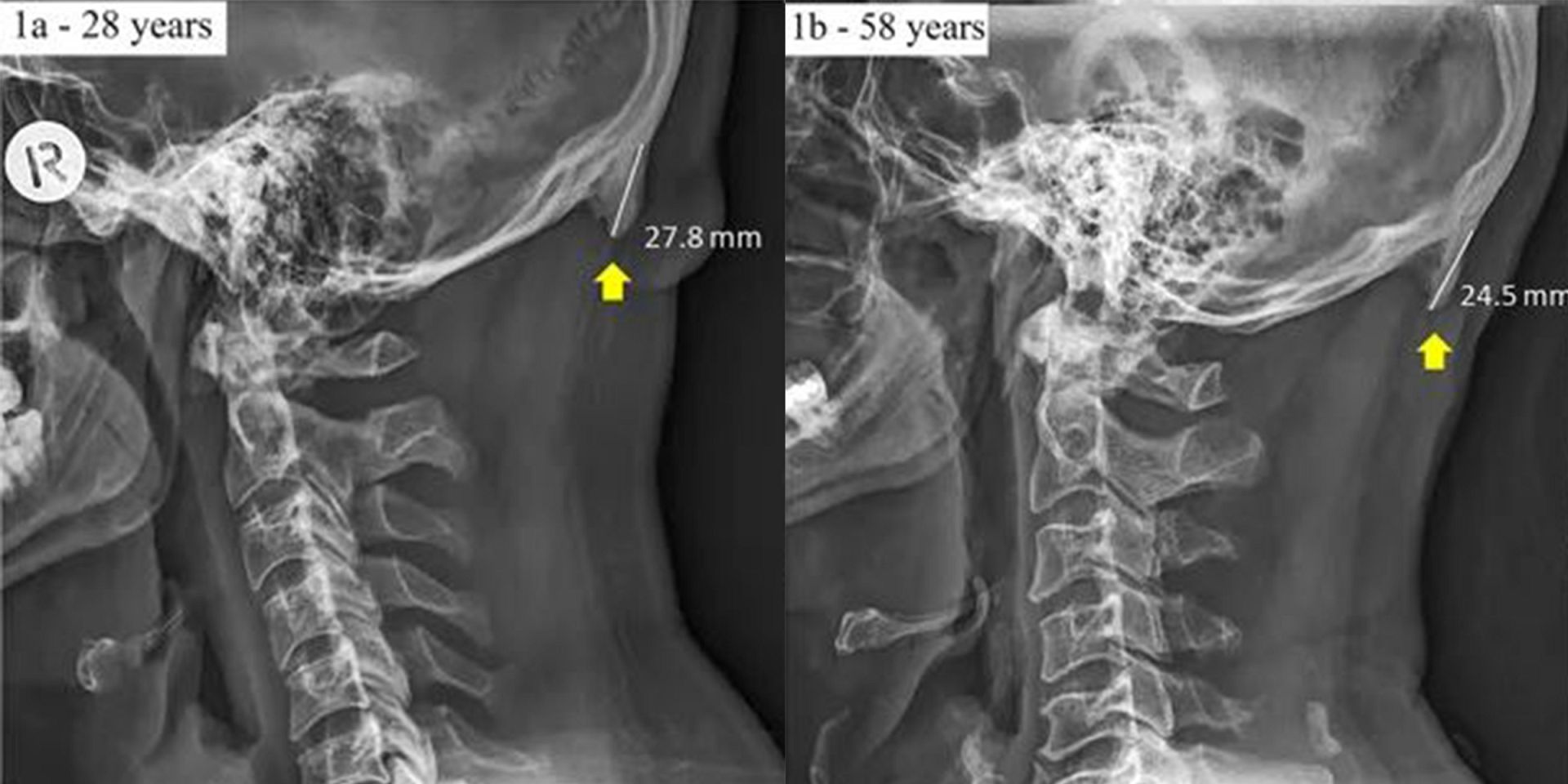 Hunching over the phone is giving some people horn-like skull bumps ...