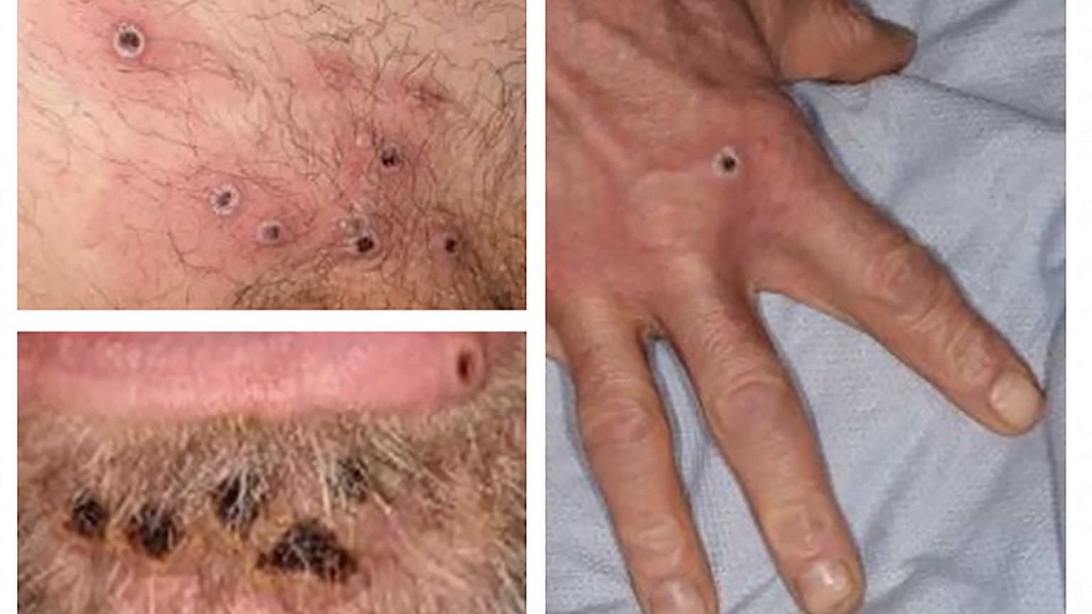 Monkeypox: Everything you should know about the virus, symptoms, risk ...