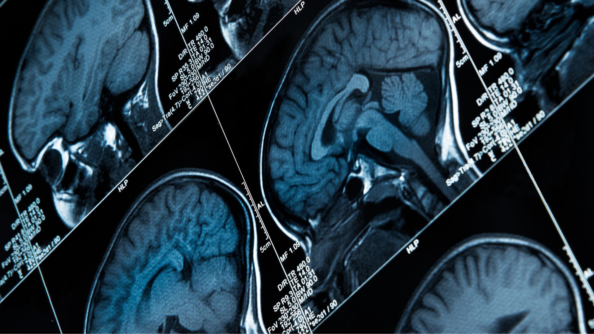 Scientists decode brain signals for pain, sparking hope for chronic ...