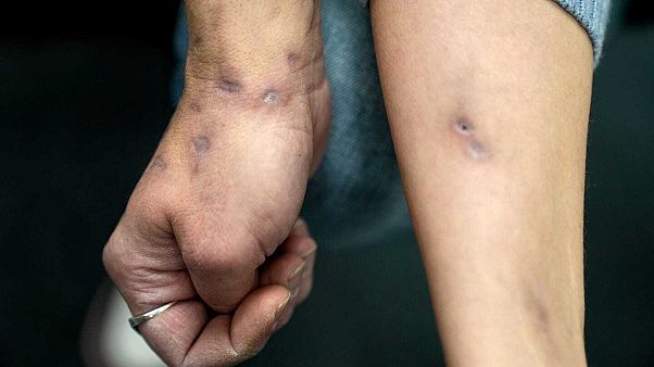 Xylazine: What to know about the flesh-eating ‘zombie drug’ spreading ...