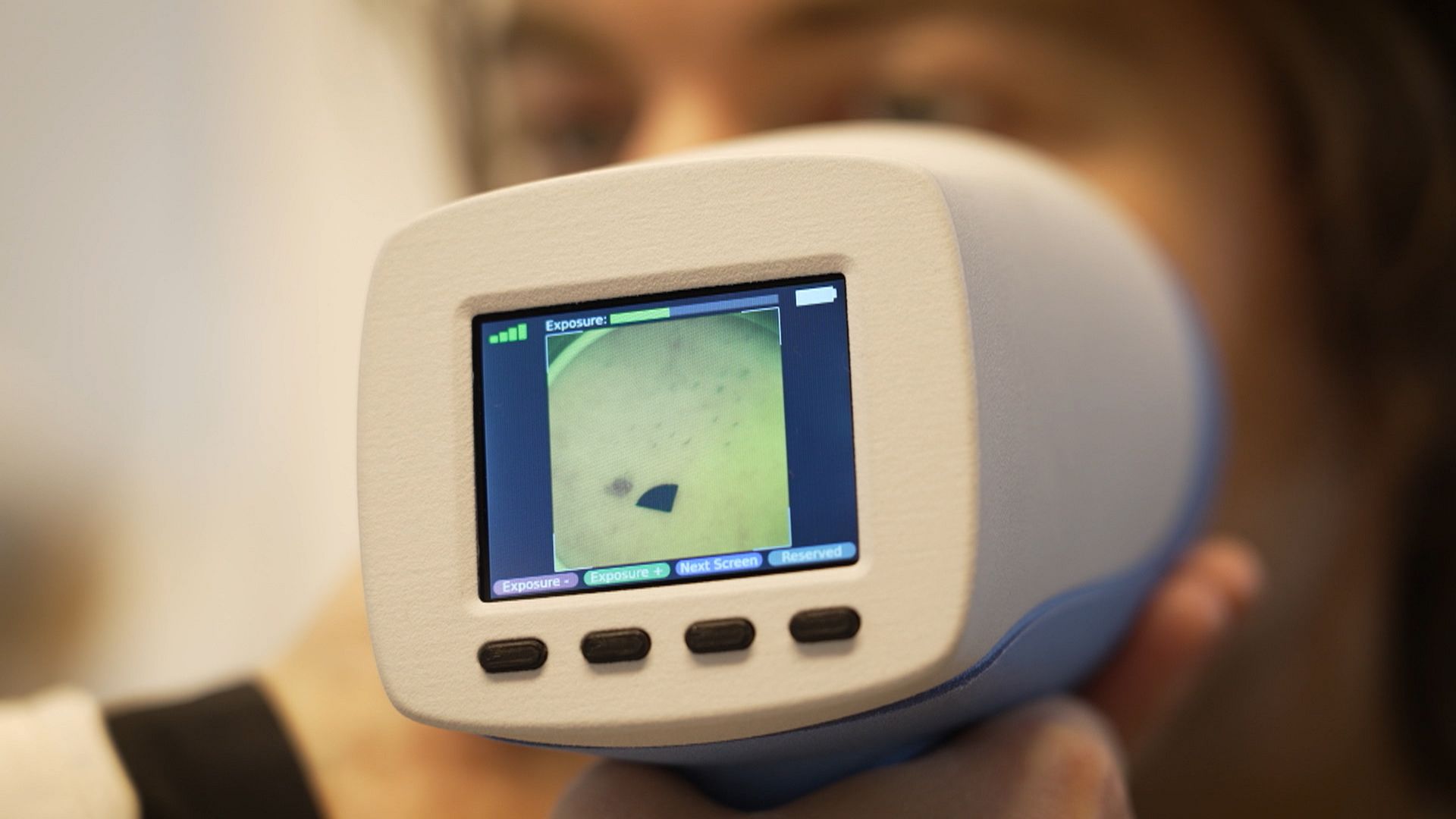 Une nouvelle technologie pour détecter les cancers de la peau en 30 ...