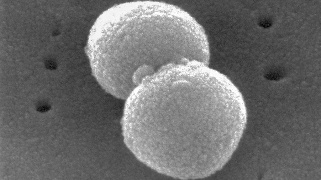 Qu'est-ce que la pneumonie, quels sont les symptômes les plus courants ...