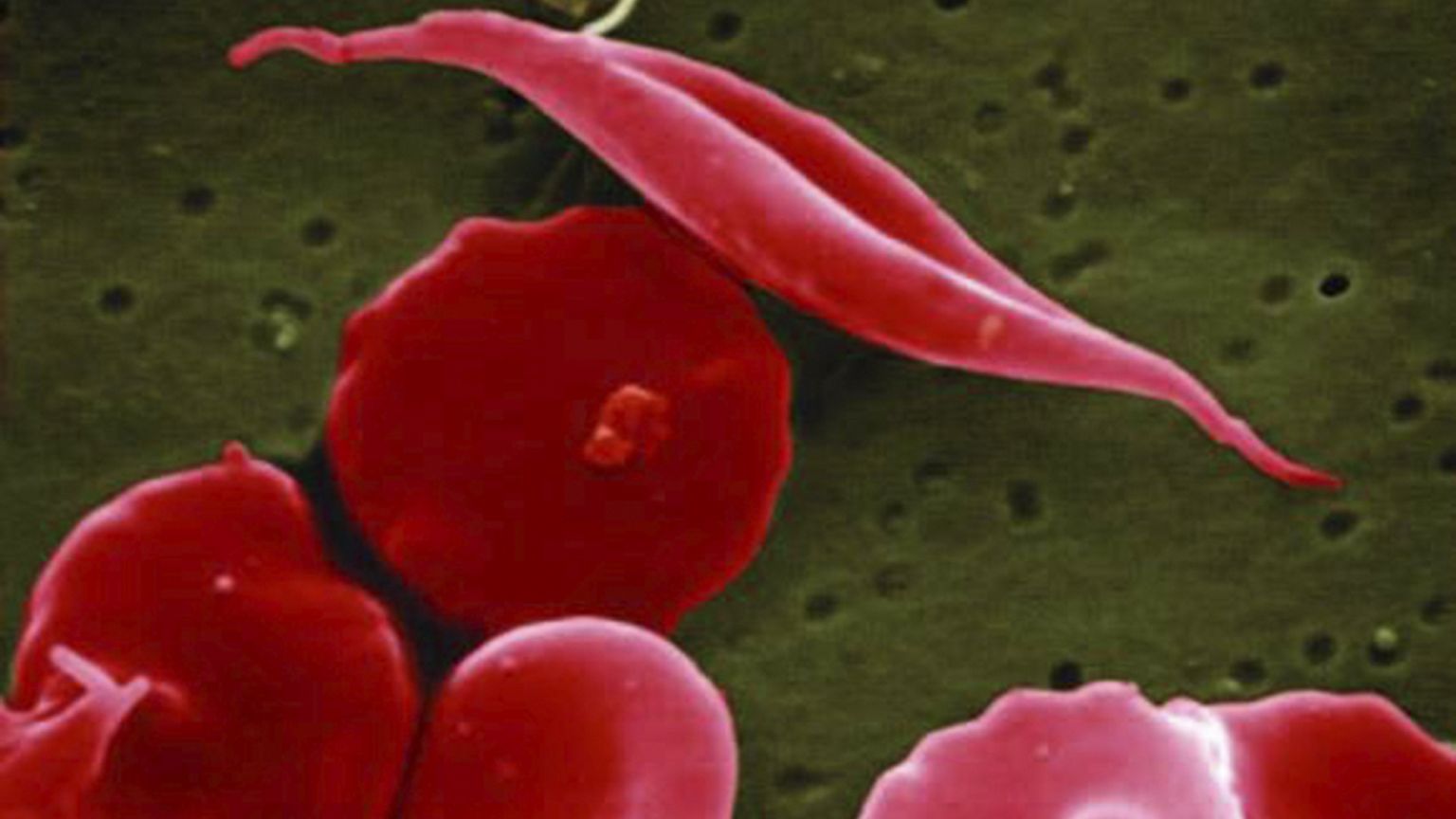 ‘Much-needed hope’ as CRISPR gene editing therapy recommended for ...